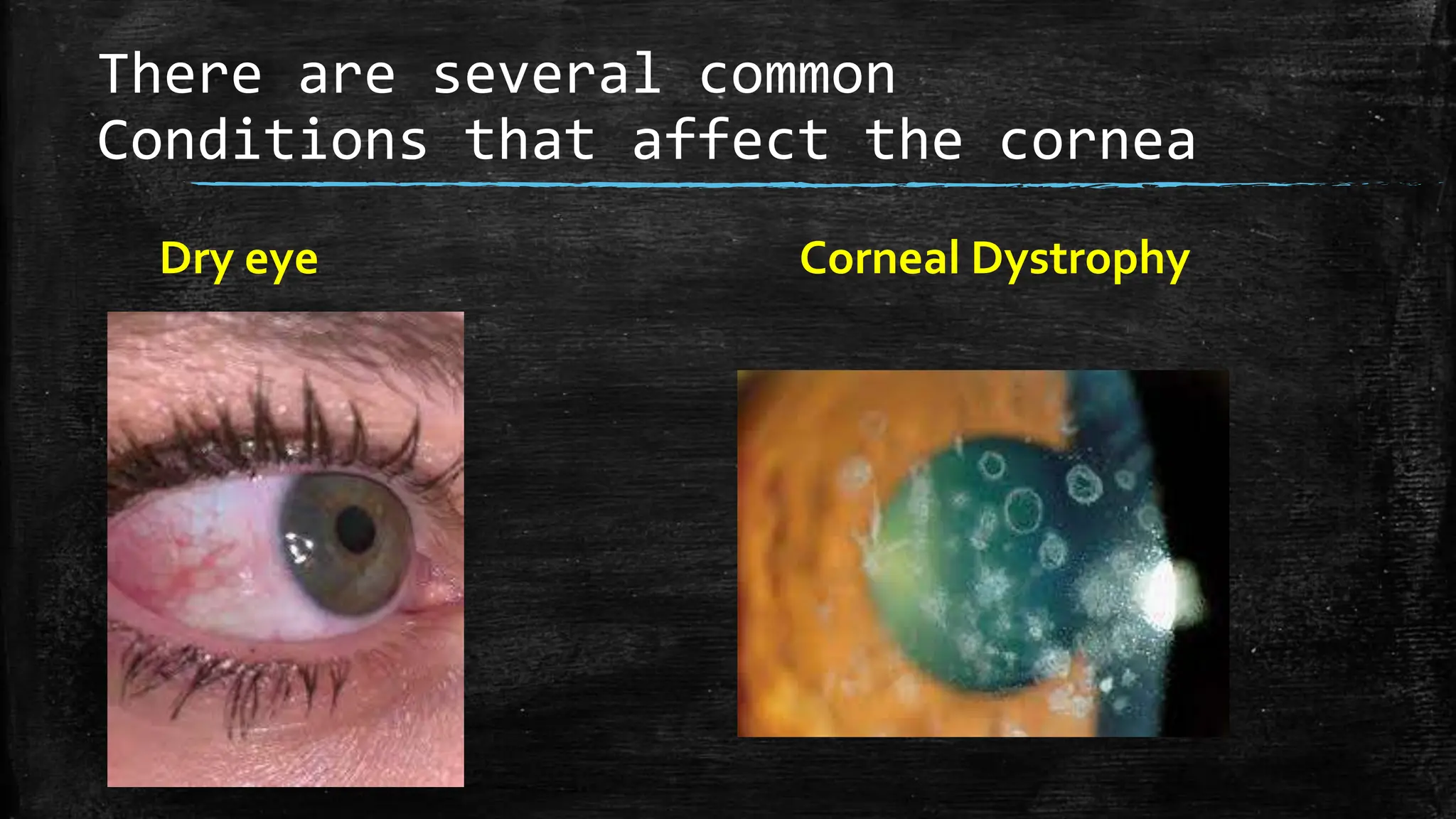 Corneal Causes of Decreased Vision.pptx