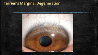 Corneal Causes of Decreased Vision.pptx