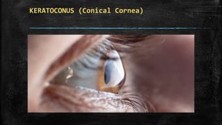 Corneal Causes of Decreased Vision.pptx