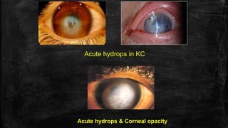 Corneal Causes of Decreased Vision.pptx