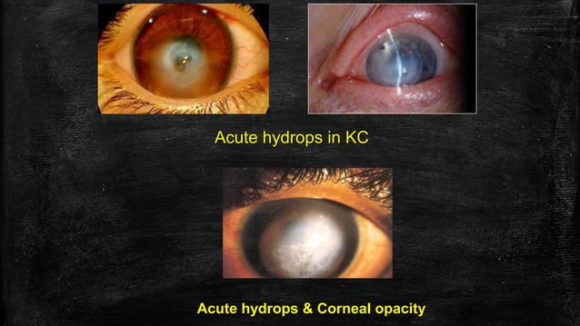 Corneal Causes of Decreased Vision.pptx