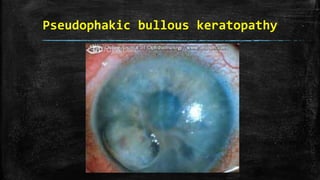 Corneal Causes of Decreased Vision.pptx