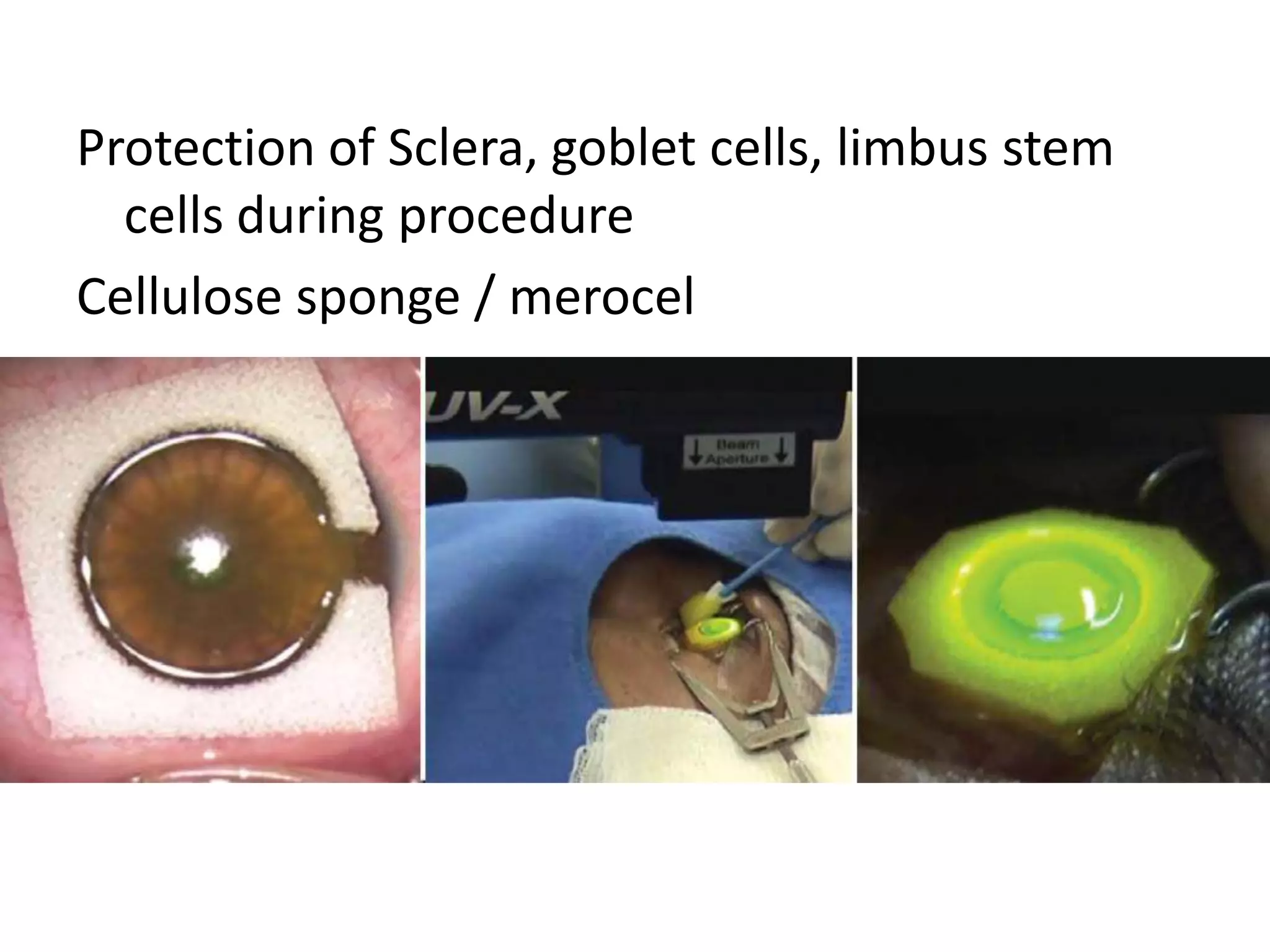 Corneal collagen cross linking | PPTX