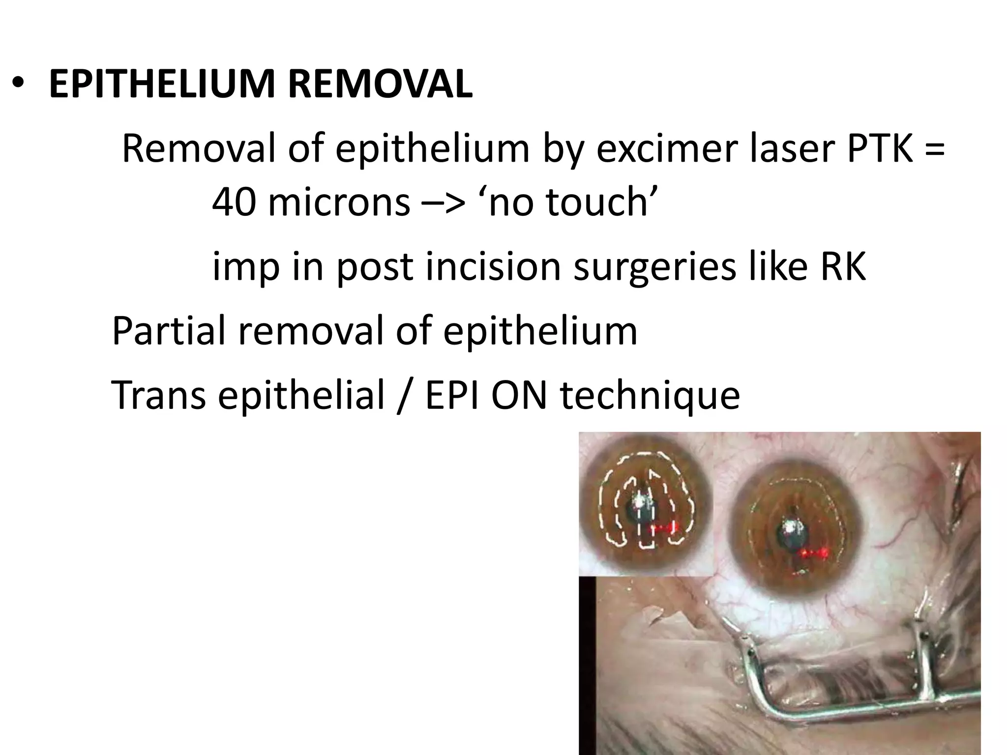 Corneal collagen cross linking | PPTX