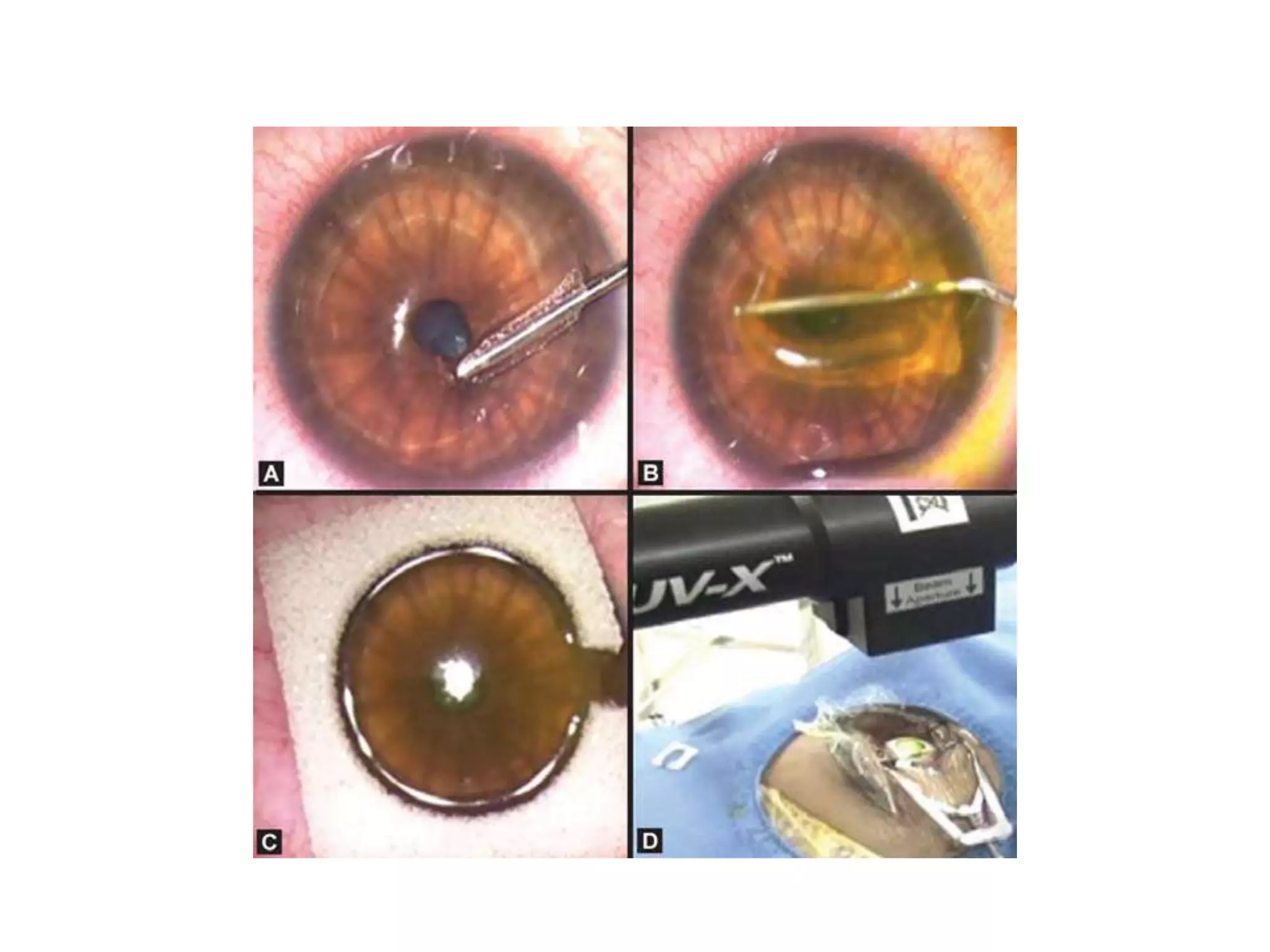 Corneal collagen cross linking | PPTX