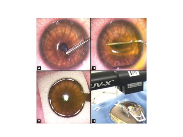 Corneal collagen cross linking | PPTX | Eye and Vision Conditions ...