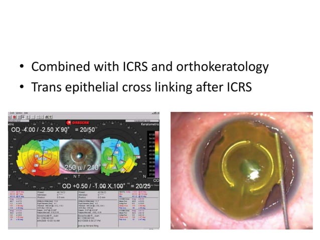 Corneal collagen cross linking | PPTX | Eye and Vision Conditions ...
