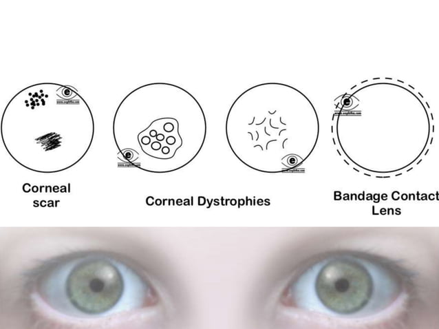 Eye colour coding | PPTX