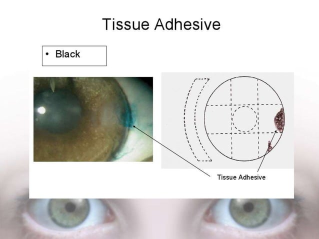 Eye colour coding | PPTX