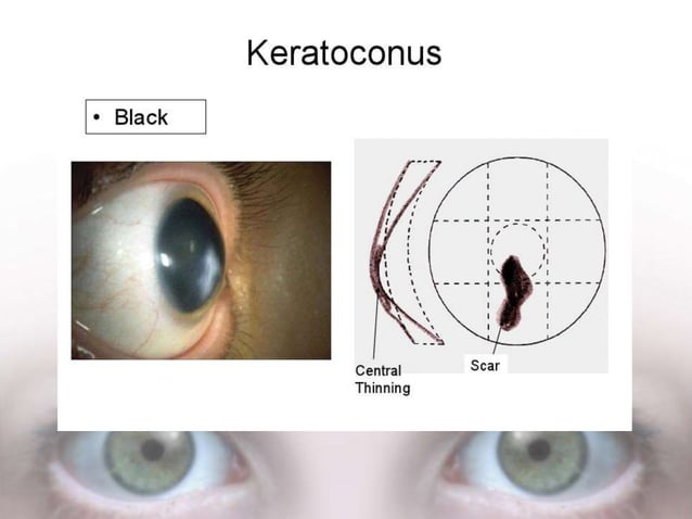 Eye colour coding | PPTX