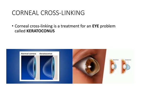 Corneal Cross-Linking .pptx | Eye and Vision Conditions | Diseases and ...