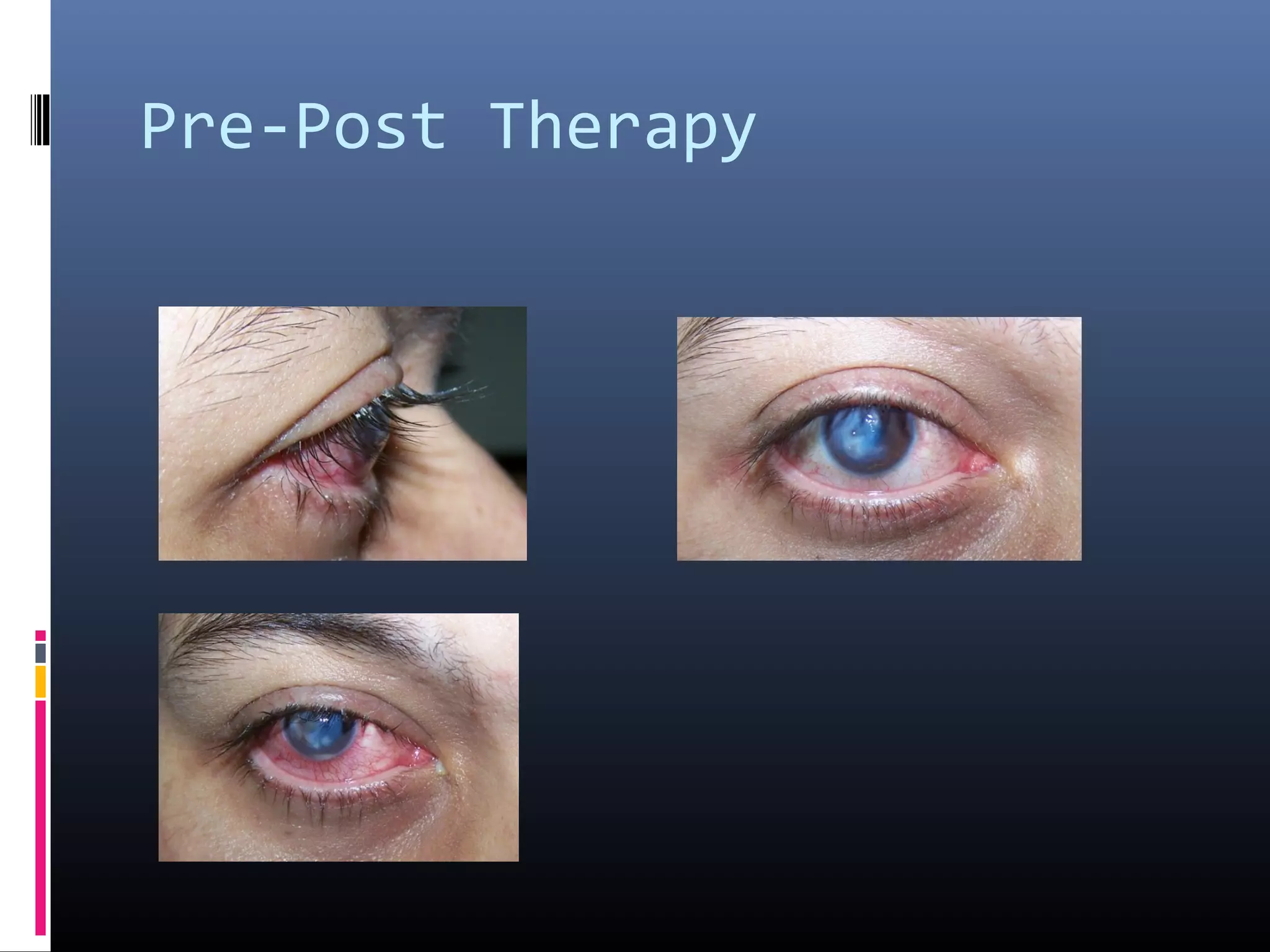 Gede Pardianto - Corneal cryo therapy for Descemetocele | PPT