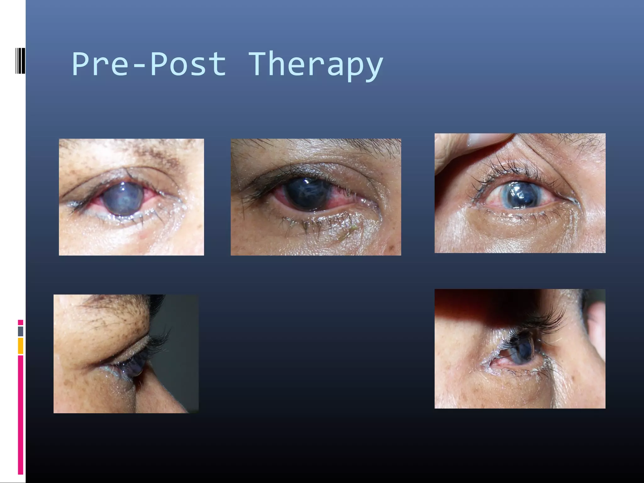 Gede Pardianto - Corneal cryo therapy for Descemetocele | PPT