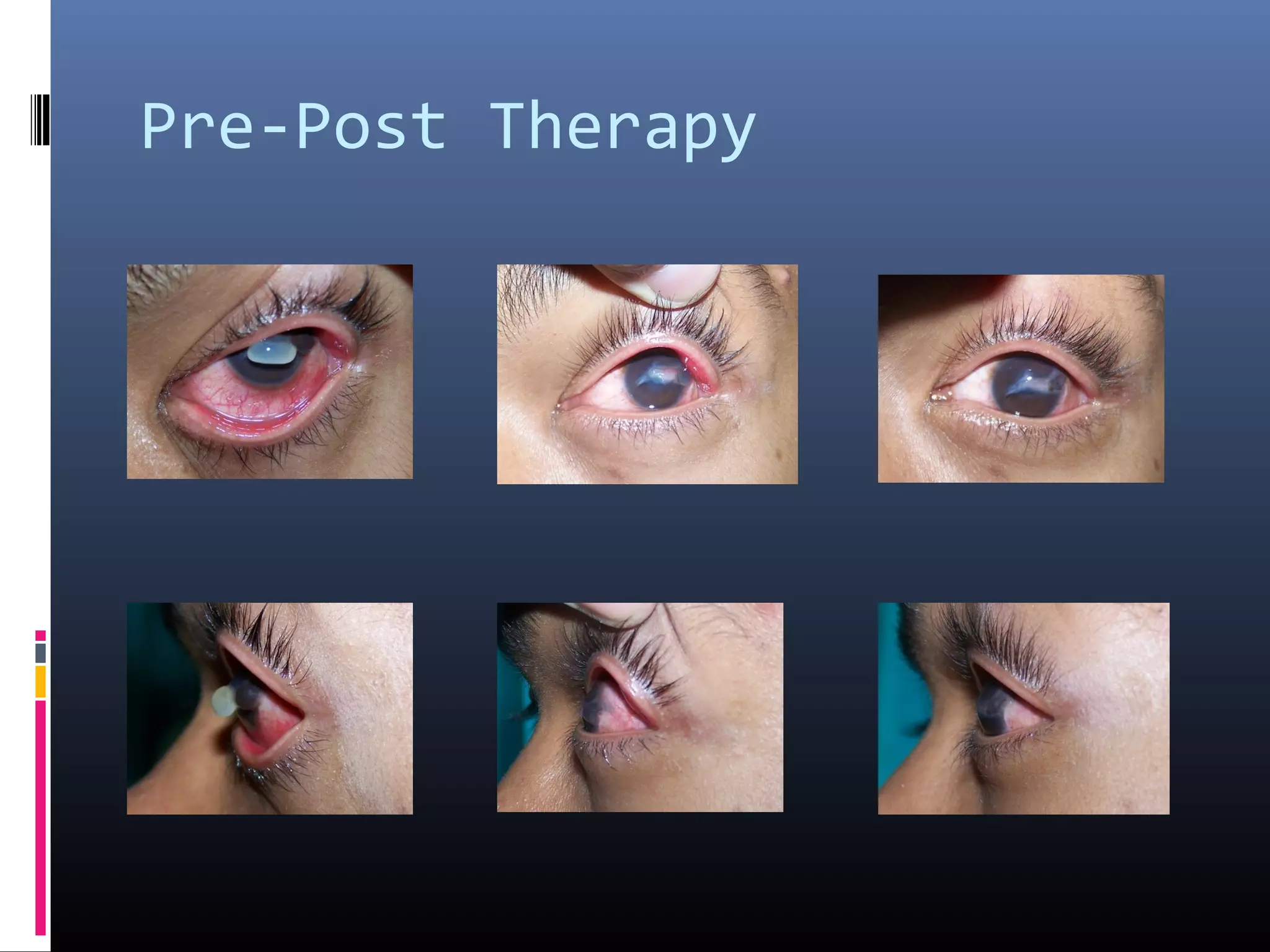 Gede Pardianto - Corneal cryo therapy for Descemetocele | PPT