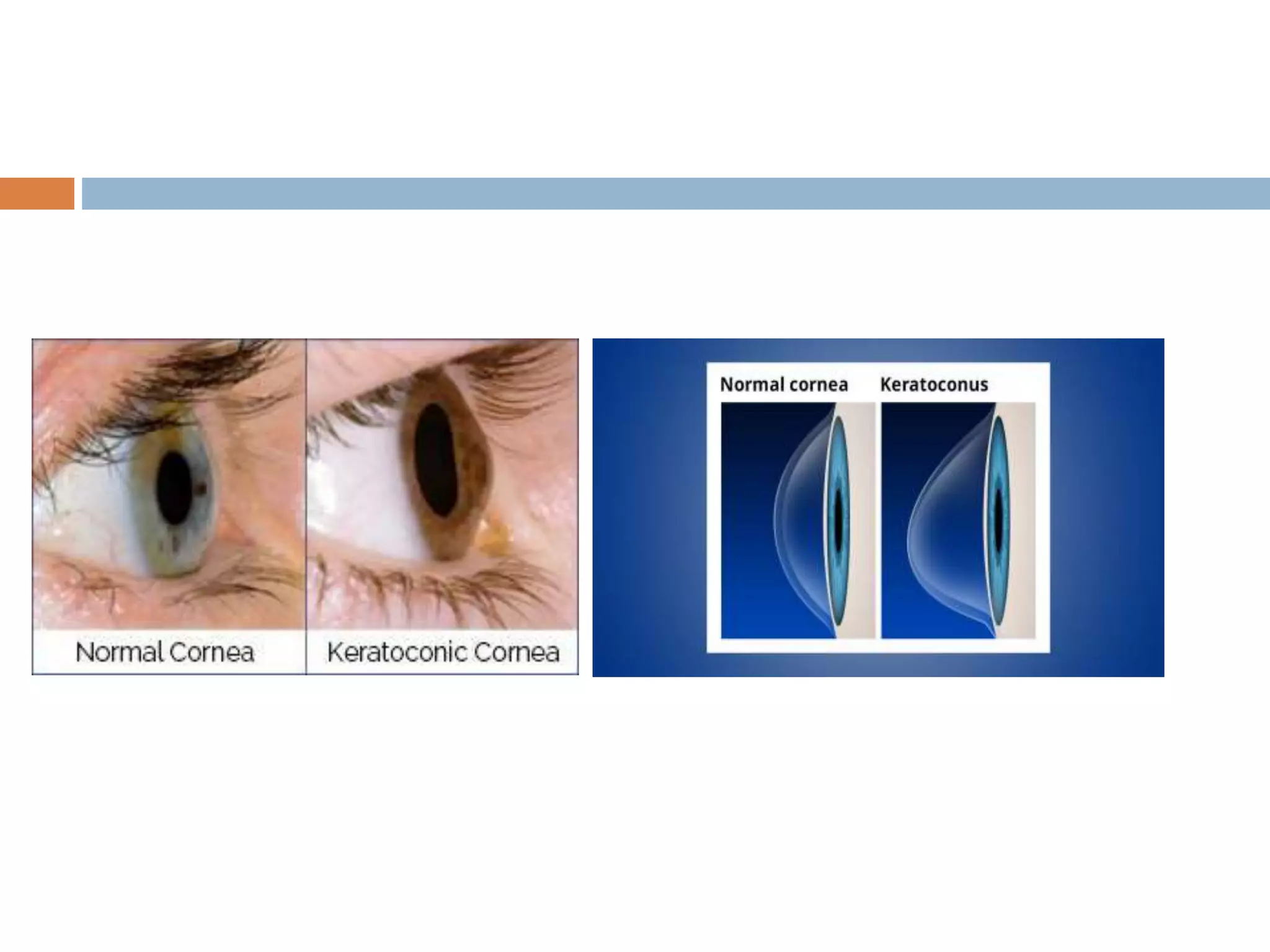 Corneal curvature and thickness | PPTX