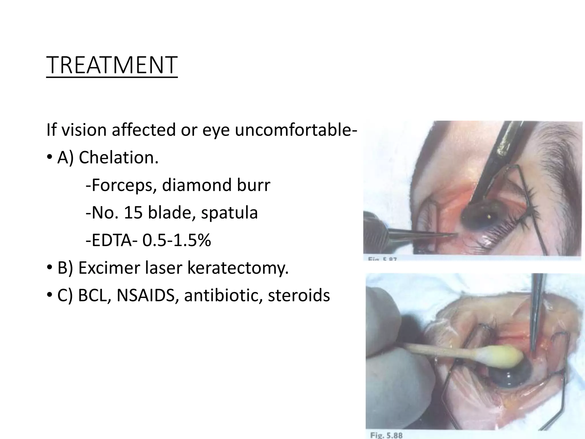 Corneal Degenerations - Dr Arnav Saroya | PPTX