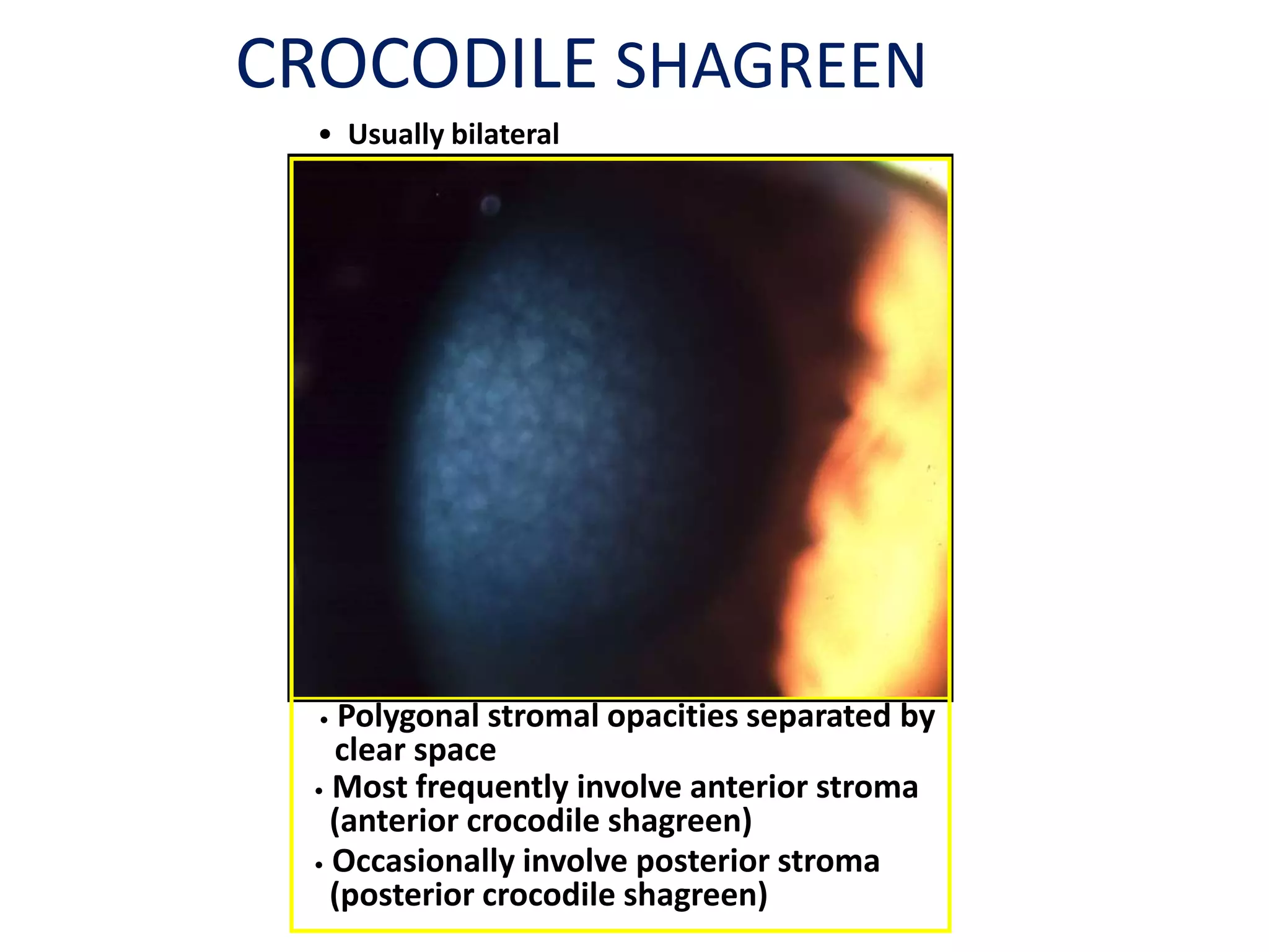 Corneal Degenerations - Dr Arnav Saroya | PPTX