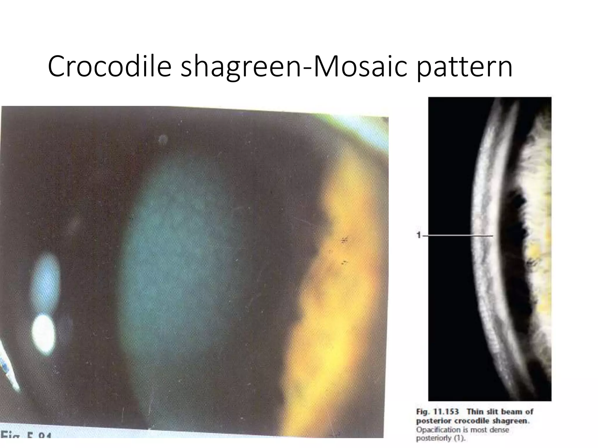 Corneal Degenerations - Dr Arnav Saroya | PPTX