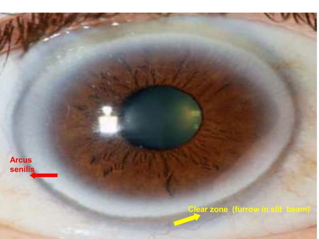 Corneal Degenerations - Dr Arnav Saroya | PPT