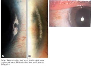 Limbal Girdle Of Vogt