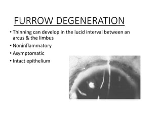 Corneal Degenerations - Dr Arnav Saroya | PPT