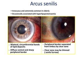 Limbus Sign And Arcus Senilis