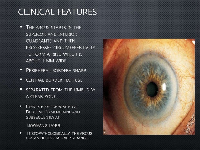 Corneal degenerations