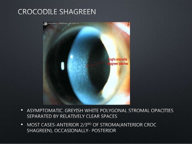 Corneal degenerations