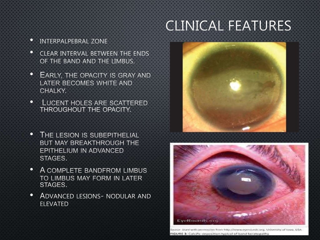 Corneal degenerations