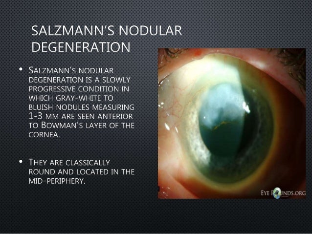 Corneal degenerations