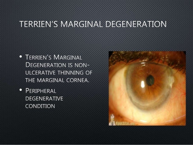 Corneal degenerations
