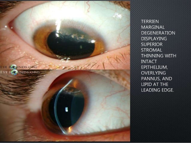 Corneal degenerations