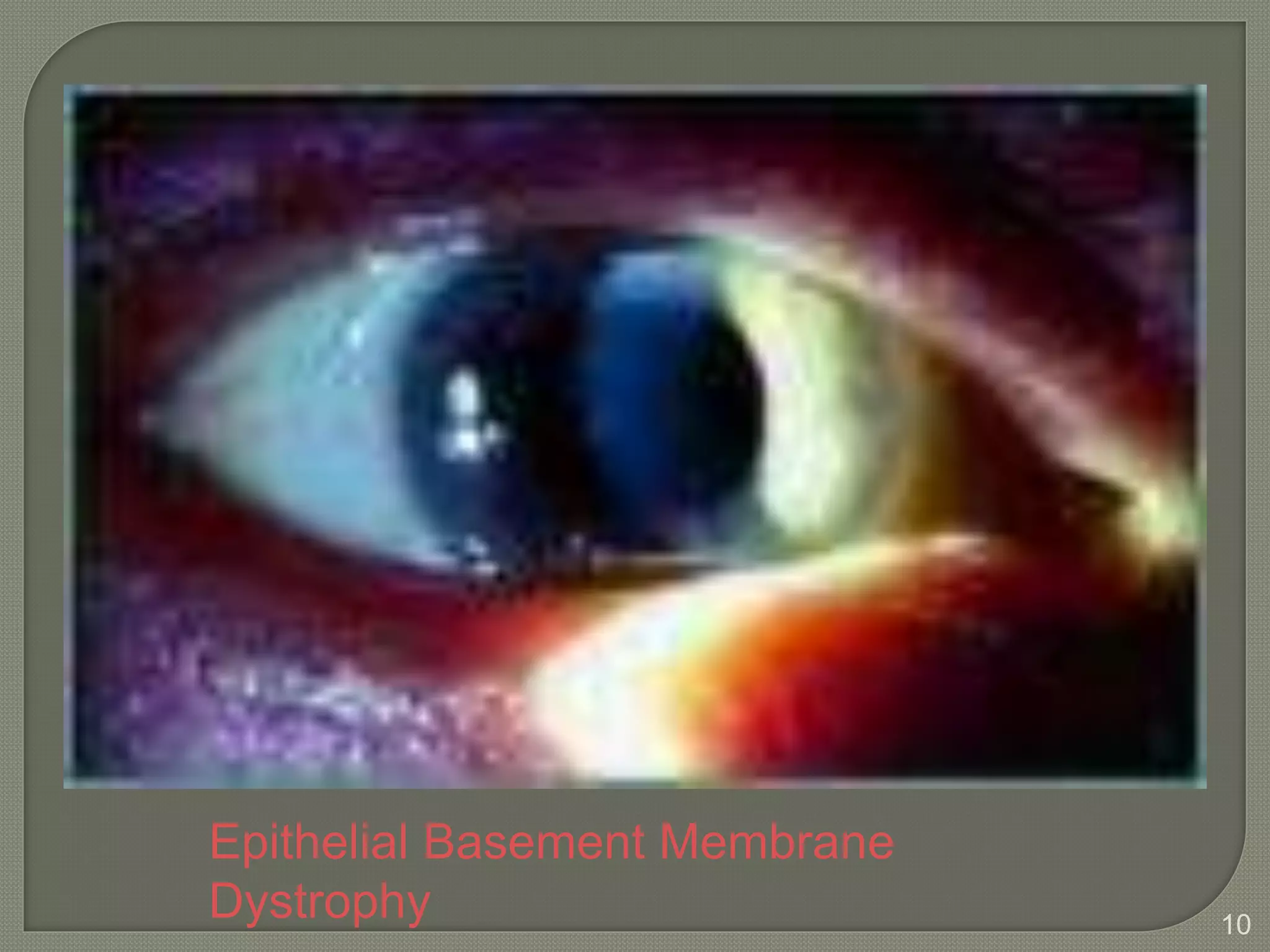 CORNEAL DEGENERATION AND DYSTROPHIES.pptx