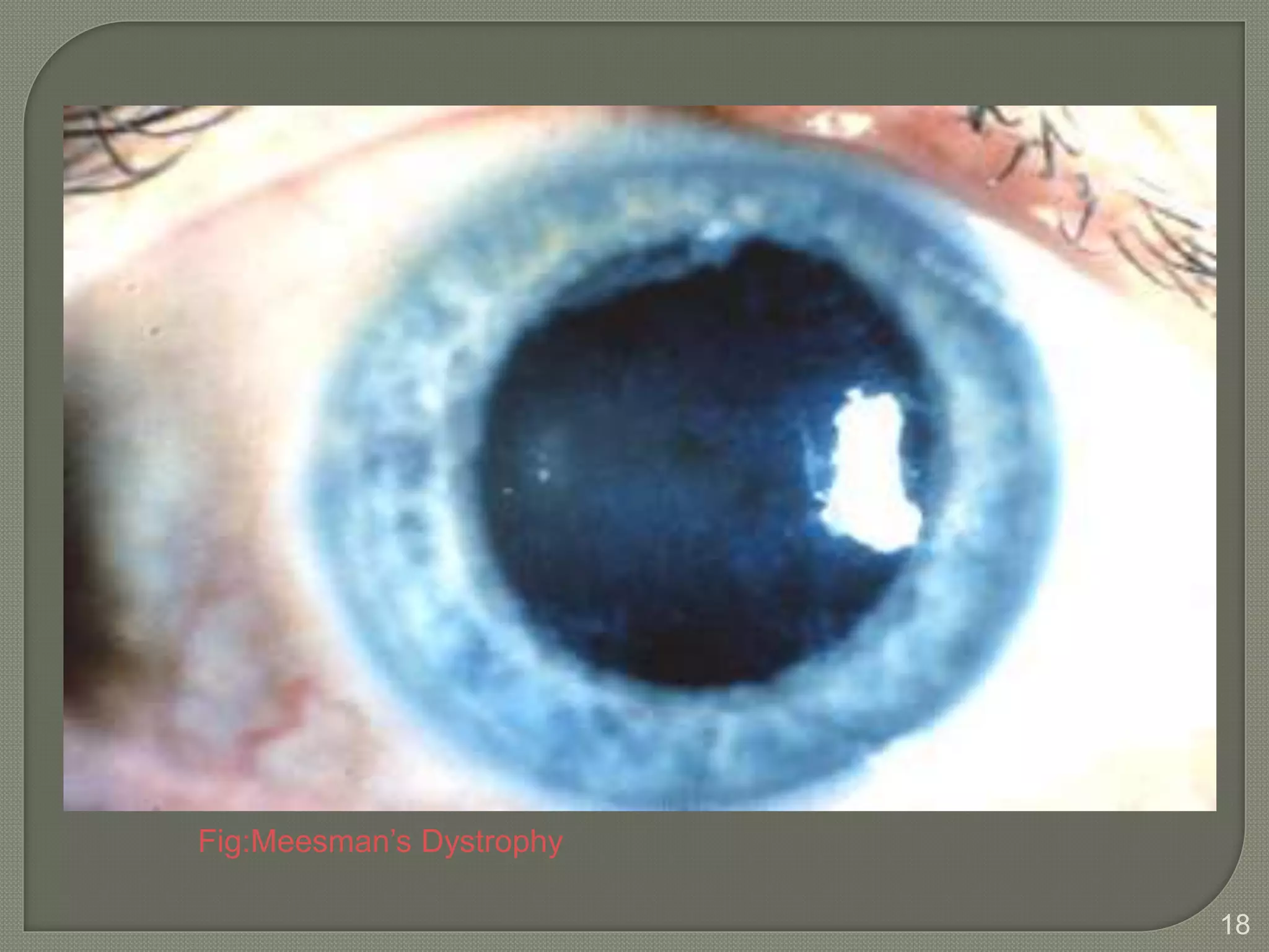 CORNEAL DEGENERATION AND DYSTROPHIES.pptx