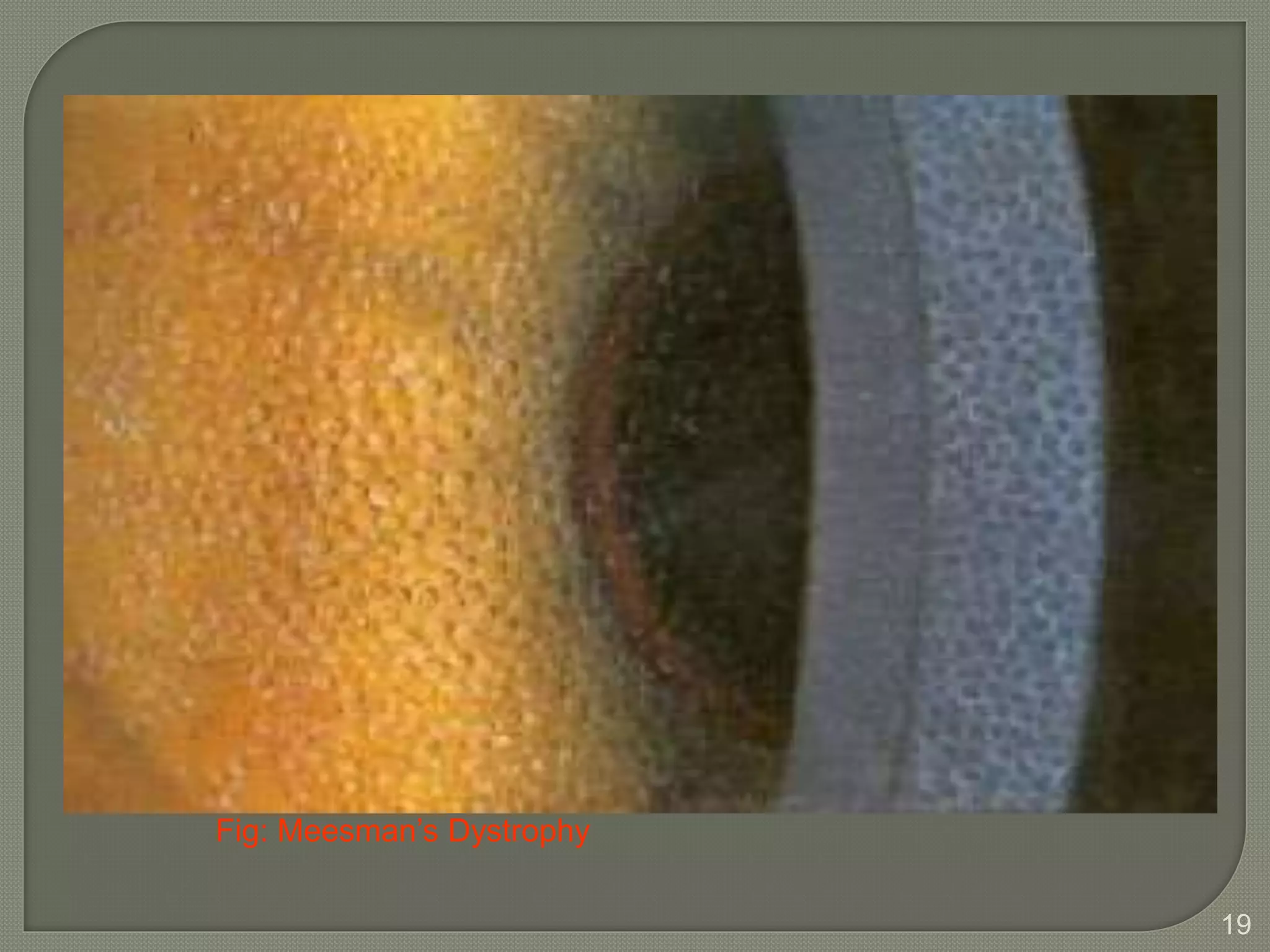 CORNEAL DEGENERATION AND DYSTROPHIES.pptx