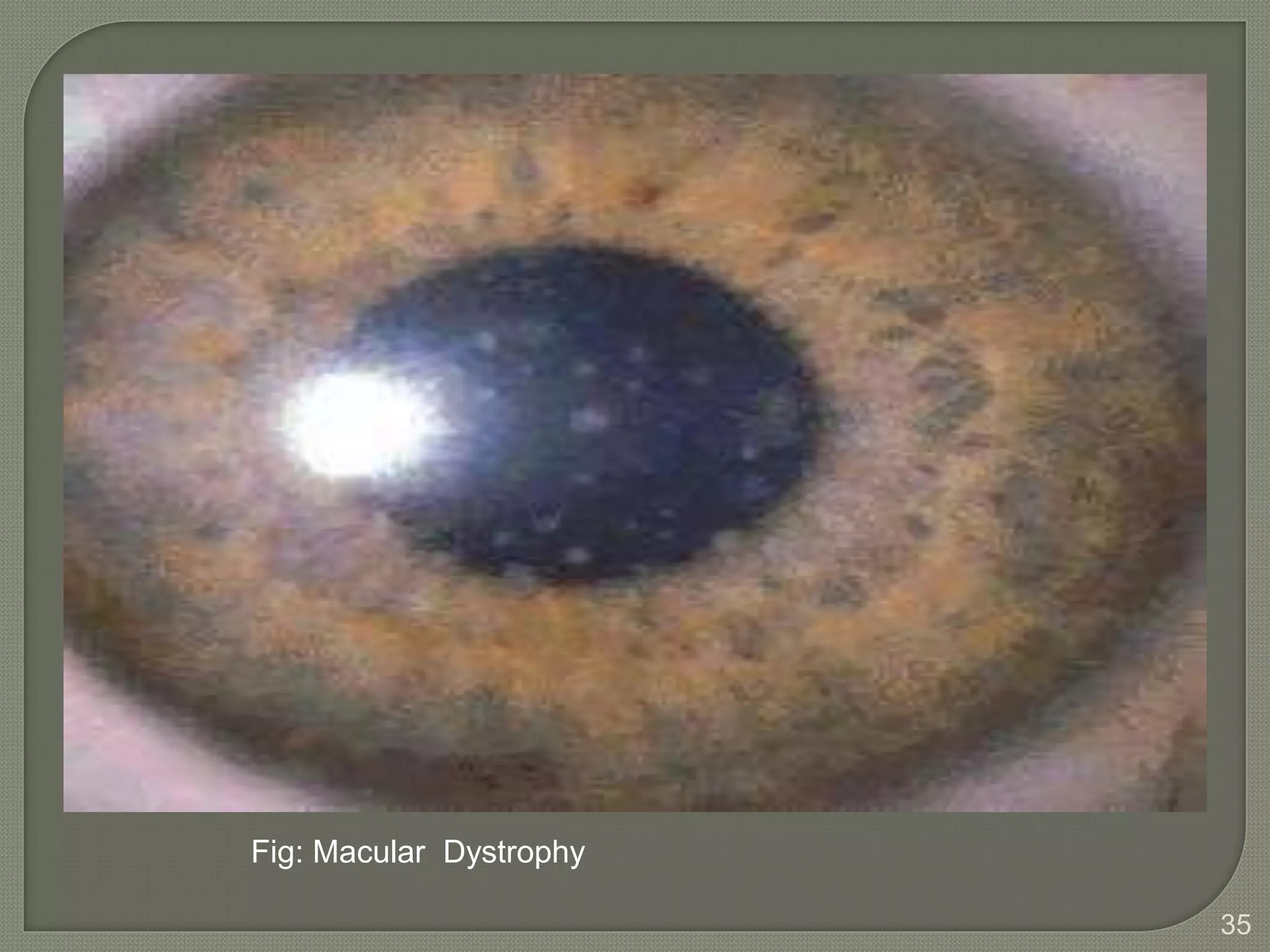 CORNEAL DEGENERATION AND DYSTROPHIES.pptx