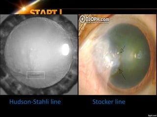 Corneal degeneration & depos | PPTX