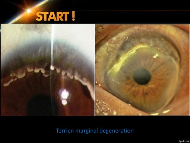 Corneal degeneration & depos