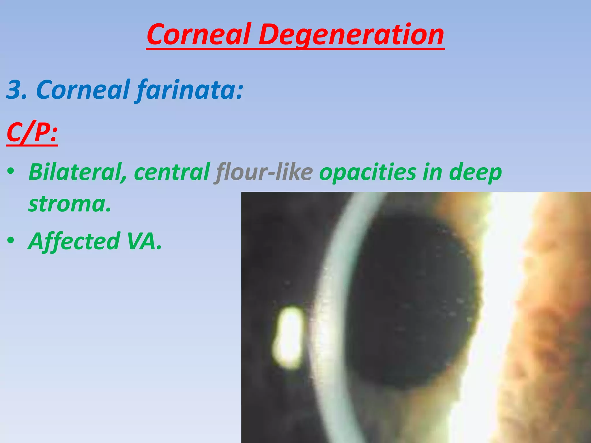 Corneal degeneration dystrophies | PPTX