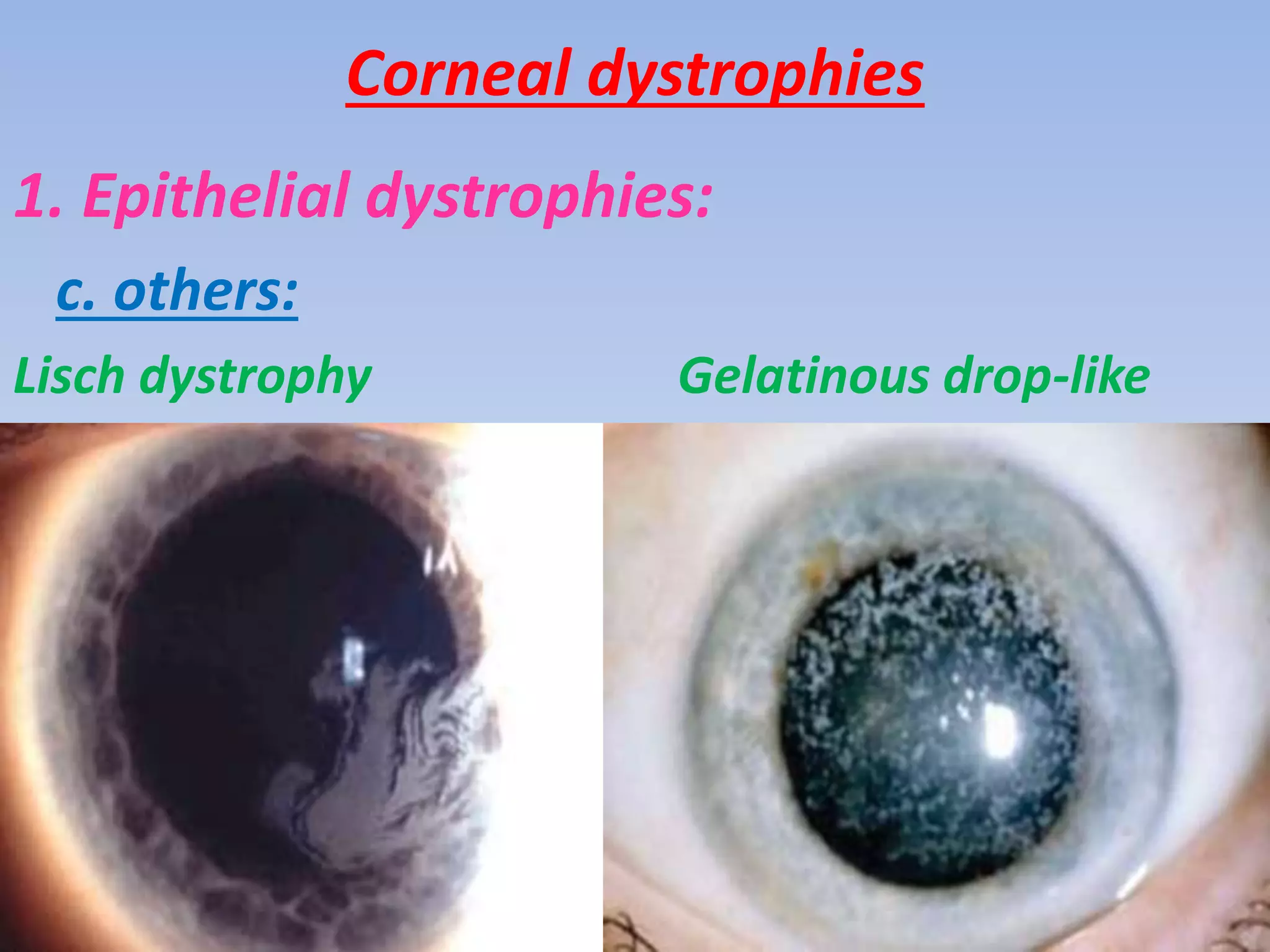 Corneal degeneration dystrophies | PPTX