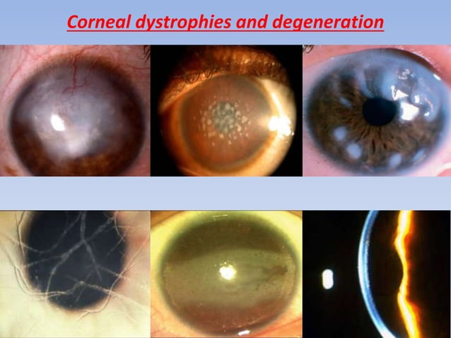 Corneal degeneration dystrophies | PPTX