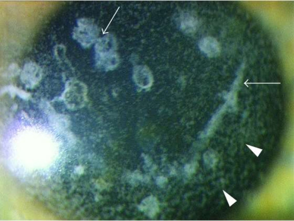 Corneal degeneration dystrophies