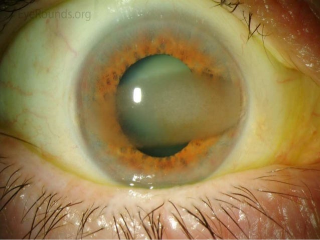 Corneal degeneration dystrophies