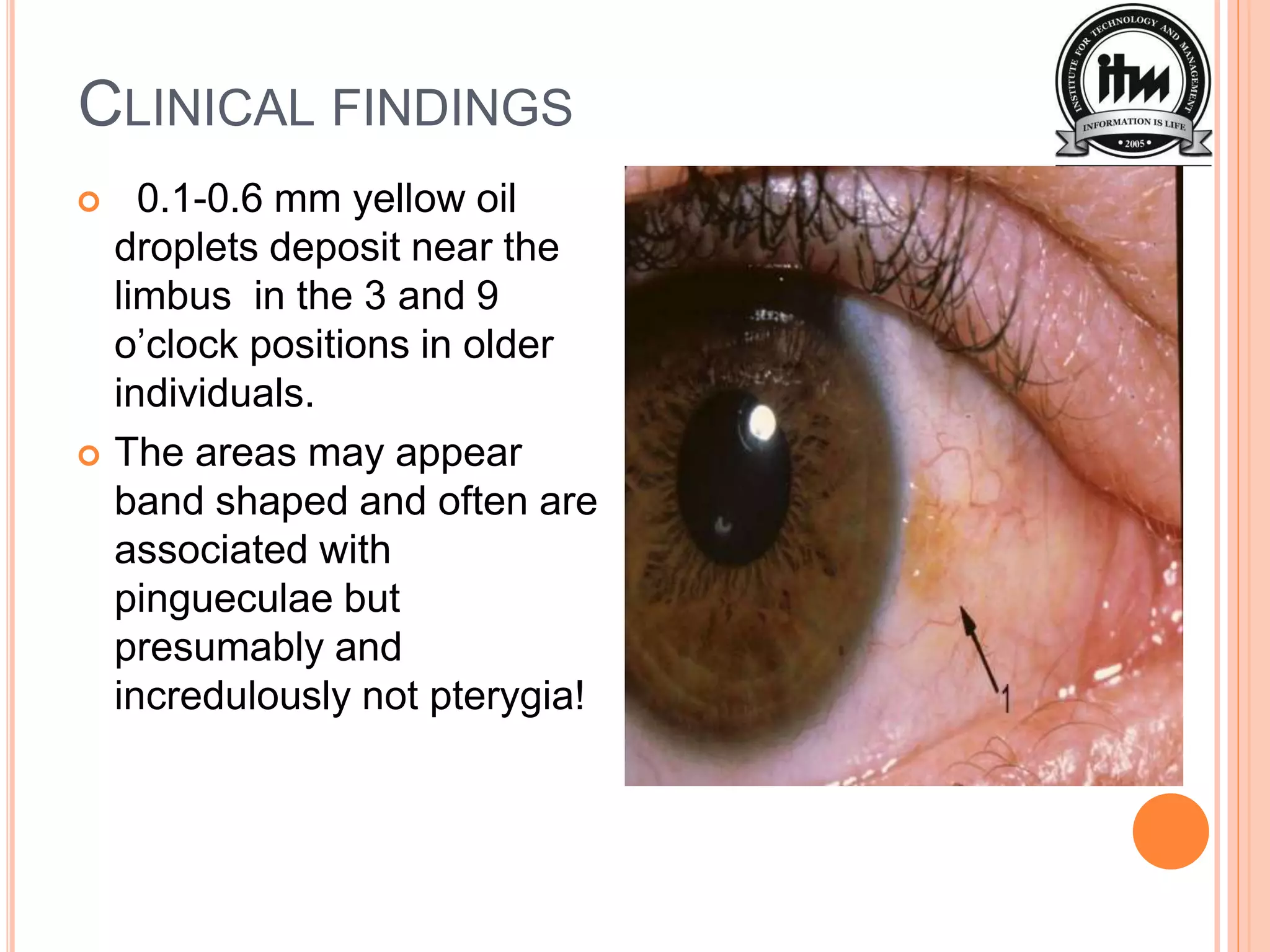 Corneal degeneration ppt | PPTX