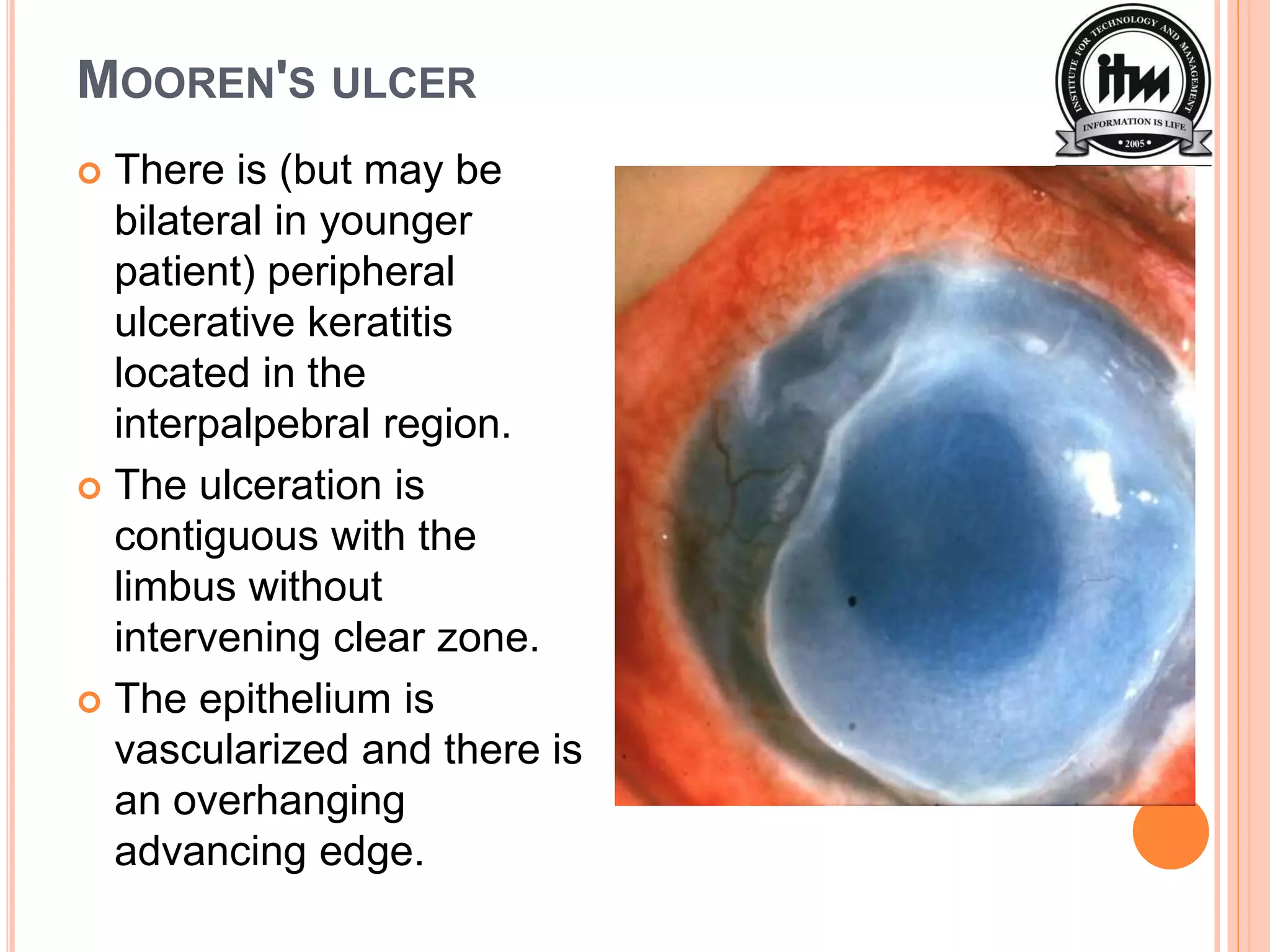 Corneal degeneration ppt | PPTX