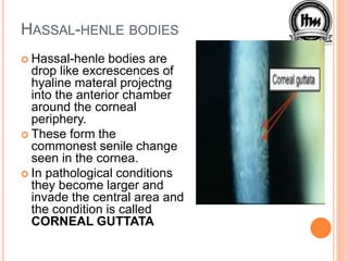 Corneal degeneration ppt | PPTX