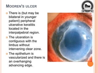 Corneal degeneration ppt | PPTX