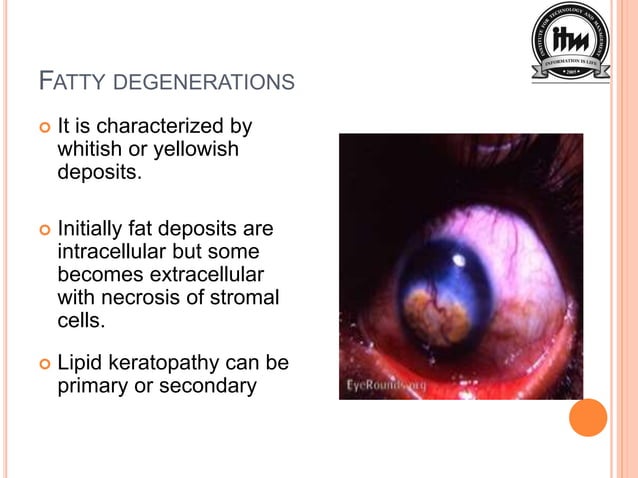 Corneal degeneration ppt