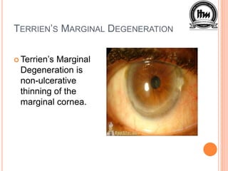 Marginal Corneal Degeneration