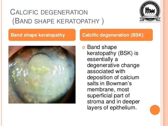 Band Keratopathy Hypercalcemia